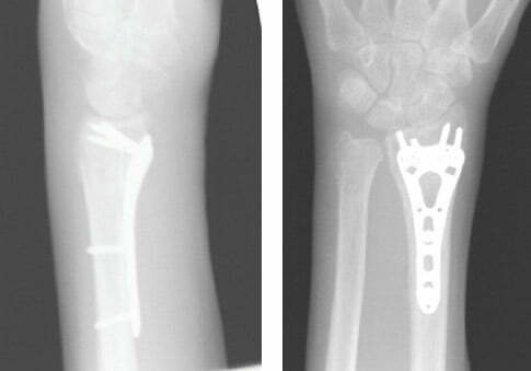 Impacted Fracture Of The Distal Radius