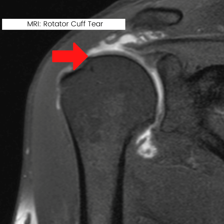 Rotator Cuff - Modern Orthopedics of New Jersey Rotator Cuff - Modern Orthopedics of New Jersey